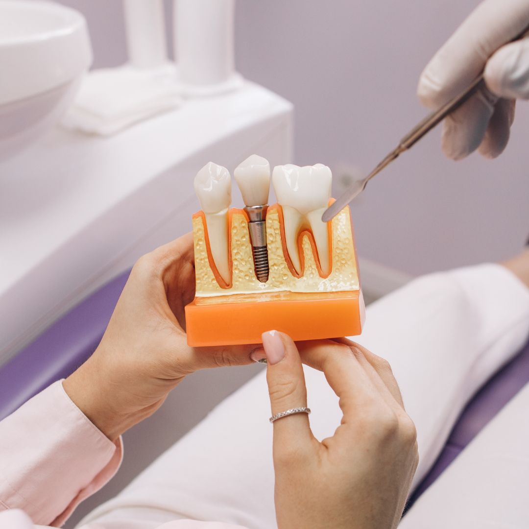 ¿Qué es un Injerto óseo? - Arancha Otero